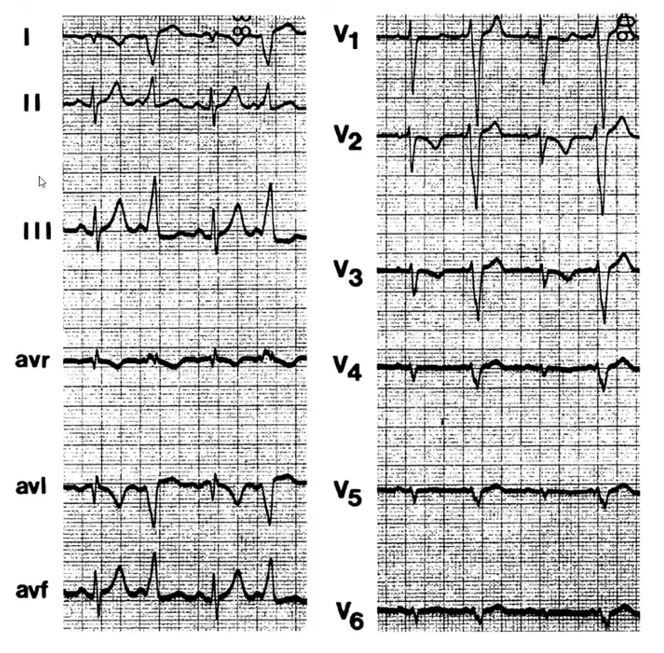 CASO ECG NOV 2021